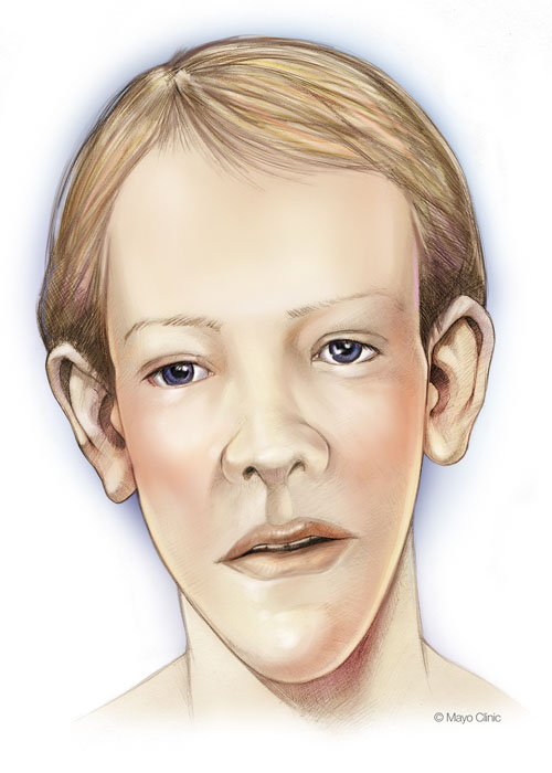 مرض متلازمة سوتو Soto's Syndrome