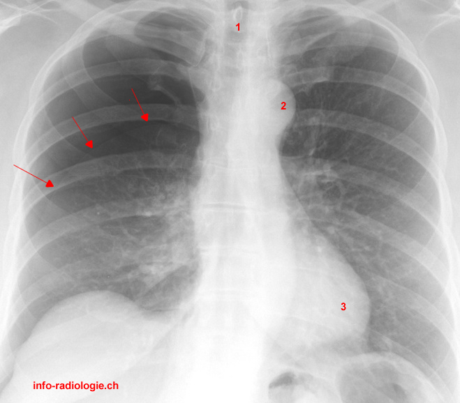 Pneumothorax (radiographies