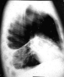 Emphysème , imagerie , radiographie thoracique