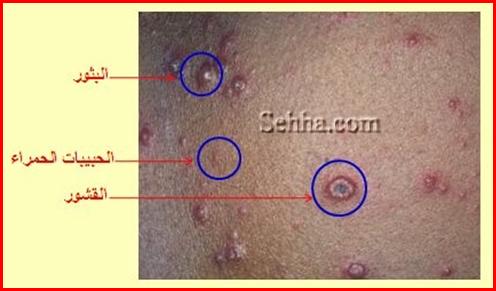 Chickenpox Varicella Chickenpox Varicella